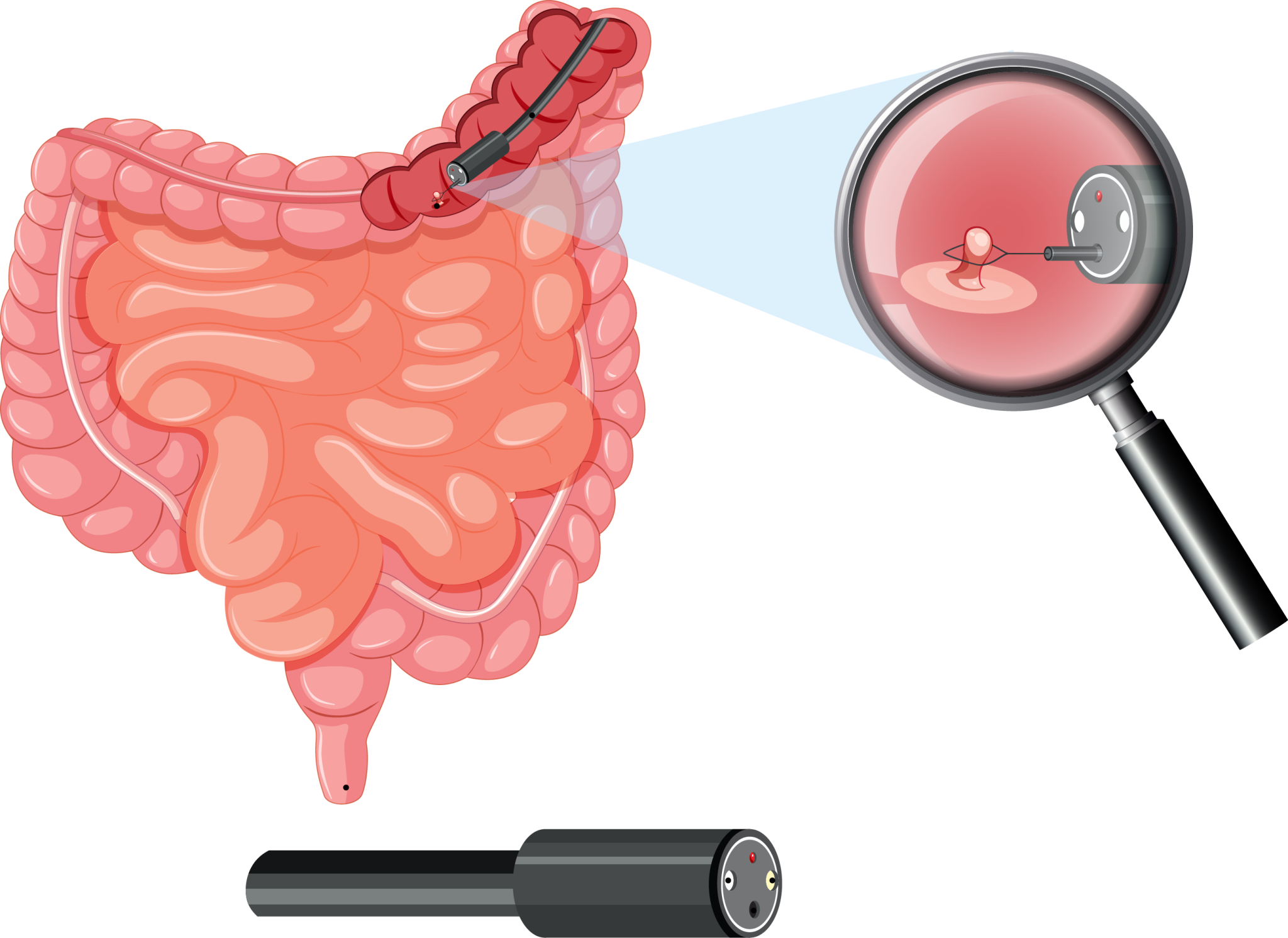 פוליפים במעי הגס - ד״ר אבי רשף - פרוקטולוג וכירורג בכיר